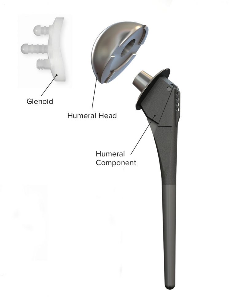 Total Shoulder Replacement - BJISG